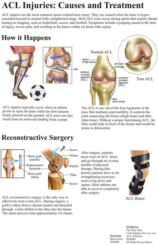 Sports Medicine — ACL Tears | FishDuck